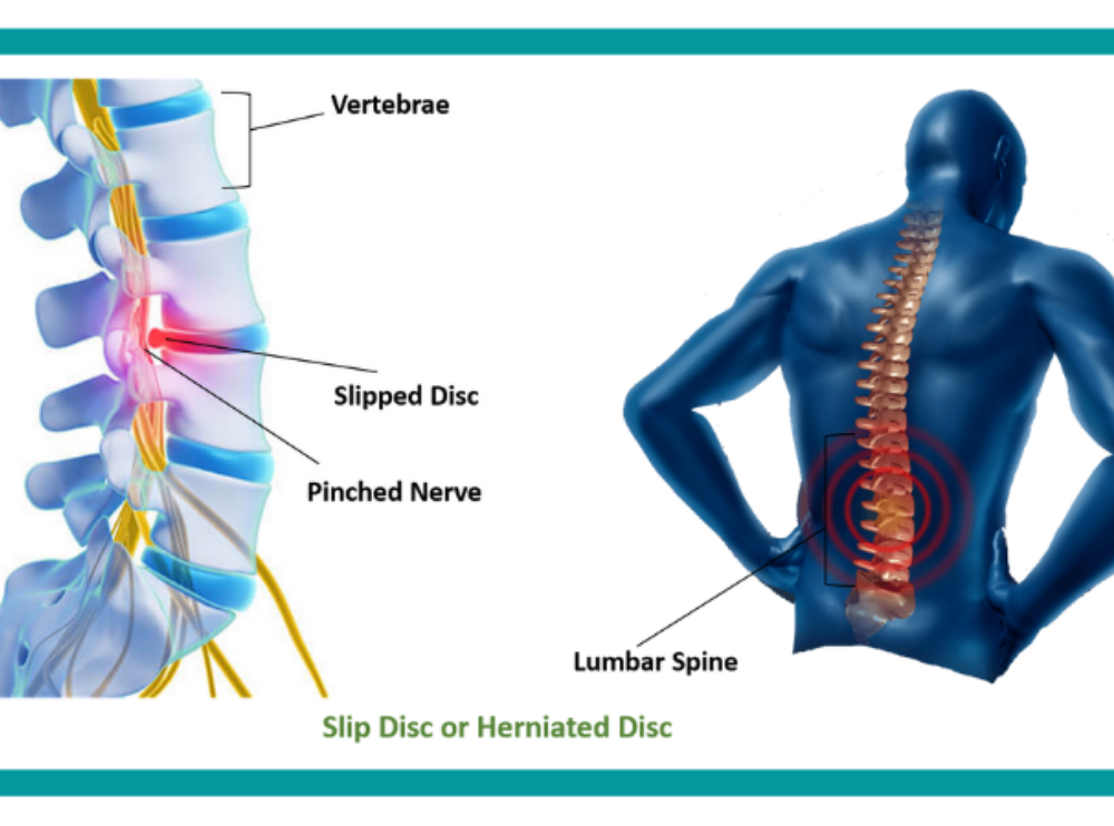 Slip Disc-Healthy Life Pain Management Center-Dr. Hitesh Patel